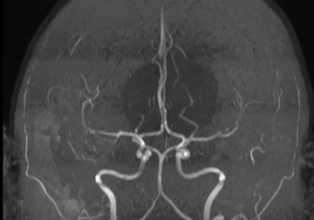 MRA Head - Mediphany