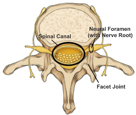 Facet Arthropathy - Low Back Pain Series - Mediphany
