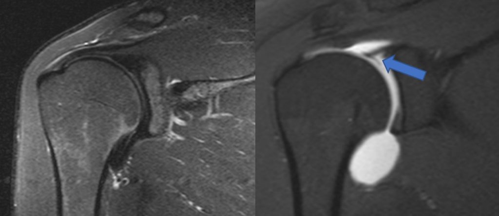 MRI Thoracic Spine - Mediphany