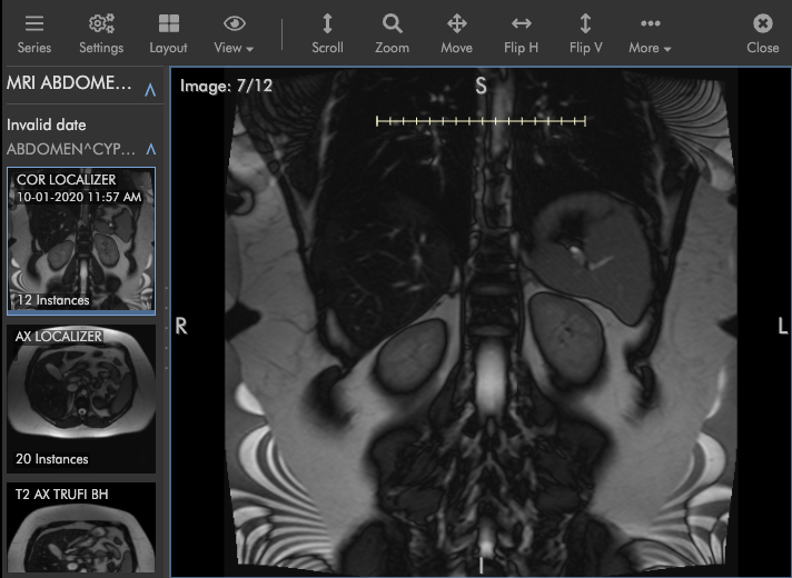 Transitional Spinal Anatomy - Low Back Pain Series - Mediphany